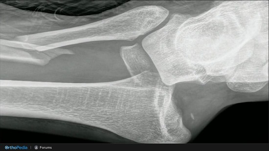 Deltoid Ligament Repair in the Setting of Acute Medial Ankle Injuries ...