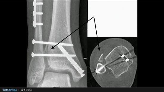 Syndesmosis Reduction Using the TightRope® XP Implant in Ankle ...