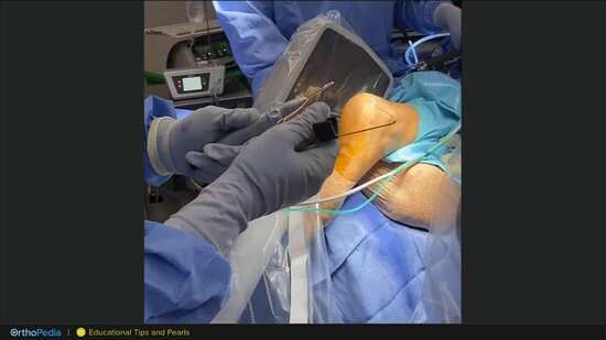 Dr. Acevedo Demonstrates Tips and Pearls for General Foot and Ankle ...