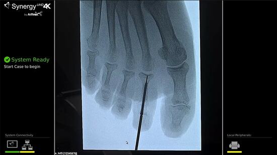 Dr. Harris Demonstrates a Pearl for Lesser Toe Deformity: Preventing ...