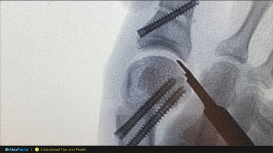 Dr. Harris Demonstrates Tips and Pearls for Hallux Valgus: MIS Bunion ...