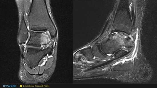 Dr. Kadakia Demonstrates Tips and Pearls for Lateral Ankle Ligament ...