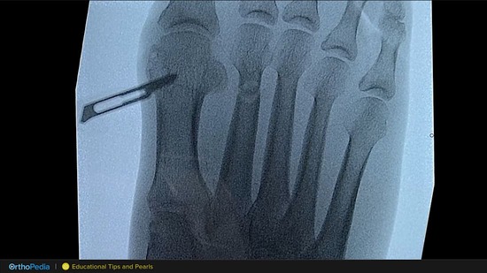 Dr. Lamour Demonstrates a Pearl for Hallux Valgus: Locating the Start ...