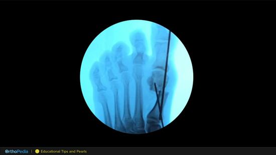 Dr. Macias Demonstrates Tips and Pearls for Hallux Valgus: Shoot First ...