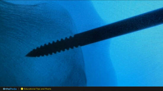 Dr. Metzl Demonstrates Tips and Pearls for Achilles Tendon Pathology: C ...