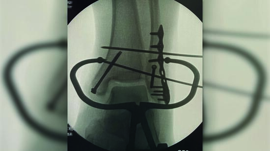 Dr. Neary Demonstrates Tips and Pearls for Ankle Fractures and ...