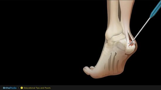 Dr. Patton Demonstrates Tips and Pearls for Achilles Tendon Pathology ...