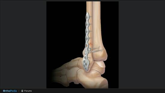 Evolution of Syndesmosis Reduction and Fixation in Ankle Syndesmosis ...