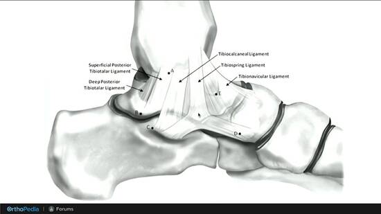 Foot and Ankle Fellowship Forum: Addressing Spring Ligament Attenuation ...