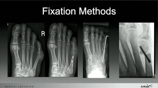 Foot and Ankle Fellowship Forum: An Overview of MIS Techniques for Foot ...