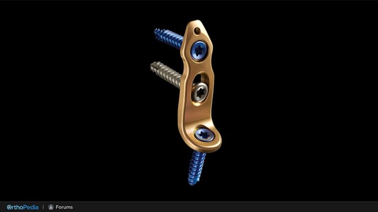 Foot and Ankle Fellowship Forum: Mini Anterior Plate Ankle Fusion ...