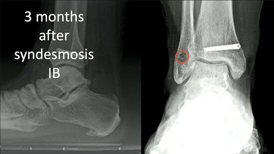 Foot and Ankle Fellowship Forum: Syndesmotic Reduction—My Preferred ...
