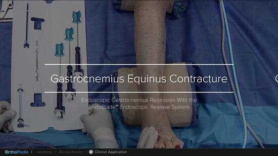 Gastrocnemius Equinus Contracture: Endoscopic Gastrocnemius Recession ...