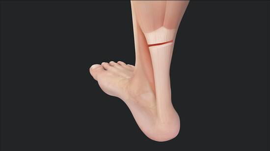 Gastrocnemius Equinus Contracture: General Surgical Considerations ...