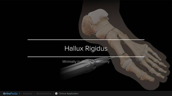 Hallux Rigidus Treatment With a Minimally Invasive Cheilectomy : OrthoPedia