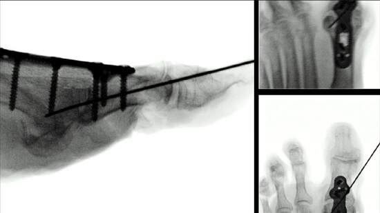 Hallux Rigidus: 1st Metatarsophalangeal Arthrodesis With the MaxForce ...