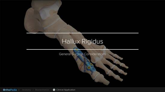 Hallux Rigidus: General Surgical Considerations : OrthoPedia