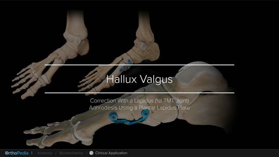 Hallux Valgus: Correction With a Lapidus Arthrodesis Using a Plantar ...