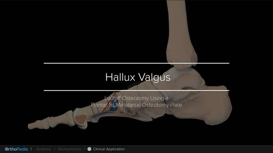 Hallux Valgus: Correction With a Ludloff Osteotomy Using a Plantar 1st ...