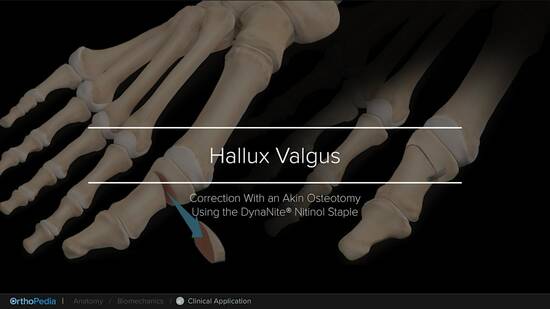 Hallux Valgus: Correction With an Akin Osteotomy Using the DynaNite ...
