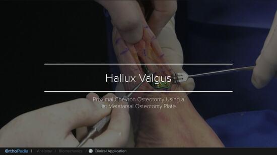 Hallux Valgus: Correction With Proximal Chevron Osteotomy : OrthoPedia