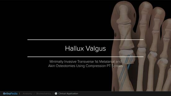 Hallux Valgus: Minimally Invasive Surgery Correction With Distal ...