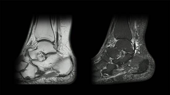 Identification of Common Pathologies of the Ankle With Arthroscopy ...