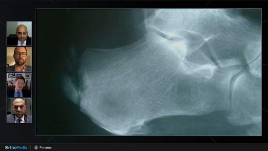 Panel Discussion on SpeedBridge™ Repairs for Midsubstance Achilles ...