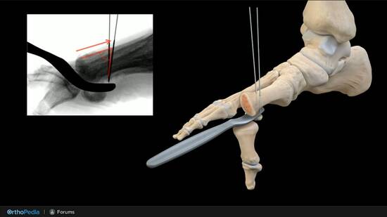 Innovations in the Treatment of Hallux Rigidus: Part 4—Background and ...