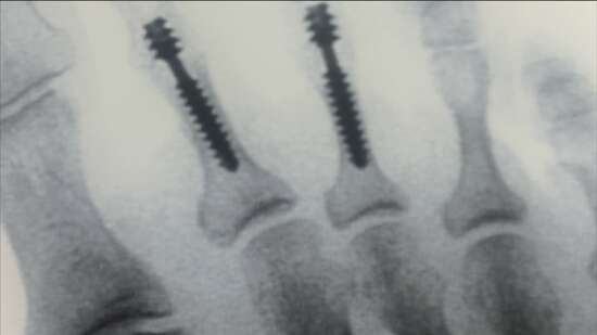 Lesser Toe Pathologies: Proximal Interphalangeal Joint Arthrodesis With ...
