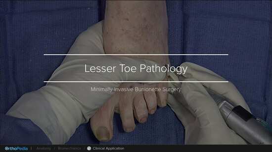 Lesser Toe Pathology: Minimally Invasive Bunionette Procedure : OrthoPedia