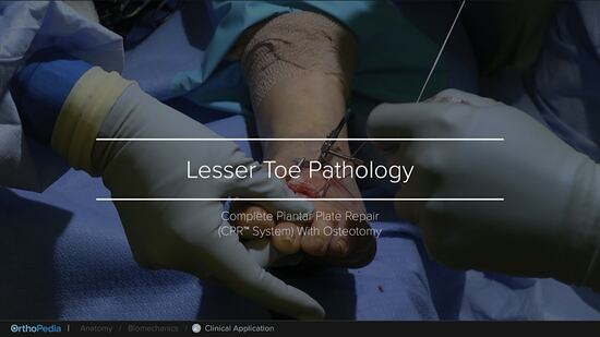 Lesser Toe: Complete Plantar Plate Repair With Weil Osteotomy : OrthoPedia