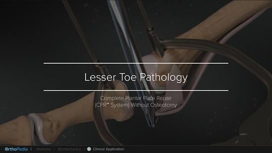 Lesser Toe: Complete Plantar Plate Repair Without Osteotomy Through a Dorsal Approach : OrthoPedia