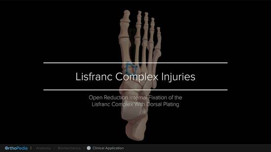 Lisfranc Complex Injuries: Open Reduction Internal Fixation of the ...