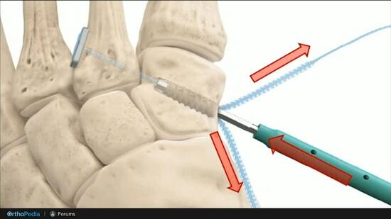 Lisfranc Injuries—Why Fuse When You Can Fix?: Part 4: Lisfranc ...