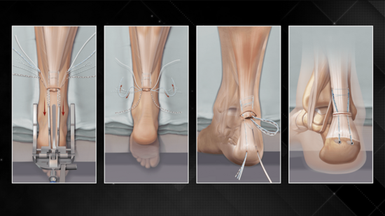 Midsubstance Achilles Tendon Rupture: Achilles Tendon Repair Using PARS ...