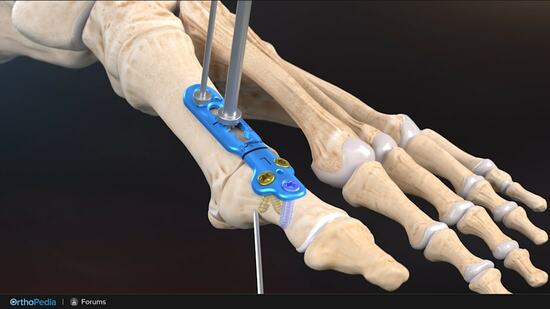 Orthopedic Technology and Innovation Forum: Hallux Metatarsophalangeal ...