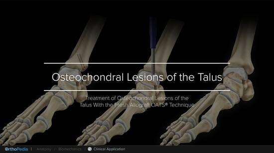 Osteochondral Lesions of the Talus: Osteochondral Allograft ...