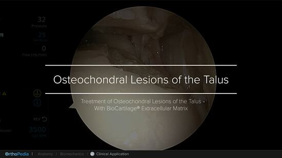 Osteochondral Lesions of the Talus: Repair With BioCartilage ...