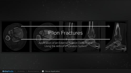 Pilon Fractures: Application of an External Fixation Delta Frame Using ...