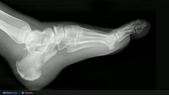 Sinus Tarsi Approach to the Calcaneal Fracture : OrthoPedia