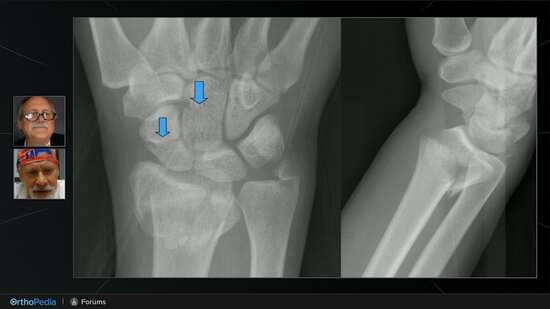 Cracking the Myth of Lunotriquetral and ECU Tears: Part 1—Clinical ...