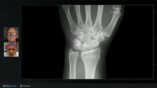 Cracking the Myth of Lunotriquetral and ECU Tears: Part 3—Ulnar ...