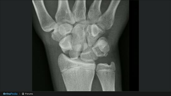 Cracking the Myth of Lunotriquetral and ECU Tears: Part 4 ...