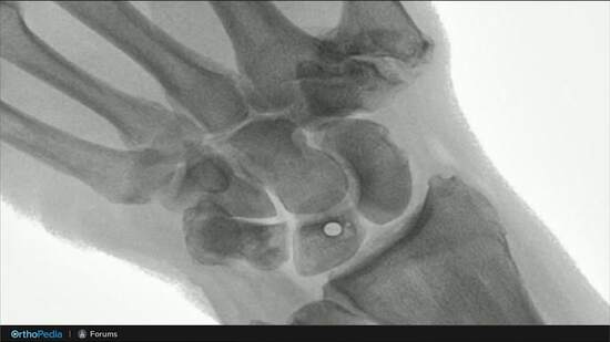 Cracking the Myth of Lunotriquetral and ECU Tears: Part 6—Perilunate ...