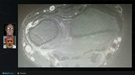 Case Discussions in the Operative Treatment of Extensor Carpi Ulnaris ...