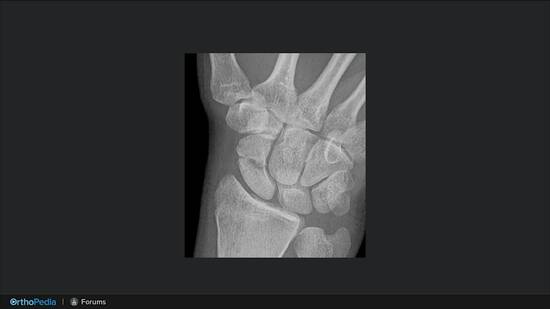 Compression FT Screw Fixation in Scaphoid Fractures : OrthoPedia