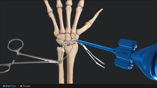 Hand and Wrist Fellowship Forum: Scapholunate Dissociation : OrthoPedia
