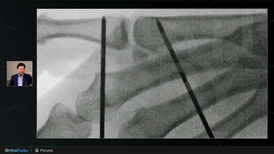 Hand and Wrist Fellowship Forum: Thumb MCP Hyperextension : OrthoPedia