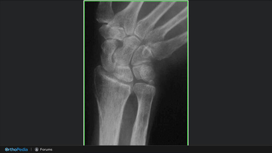 Hand, Wrist, and Elbow OTIF: Axial Instability of the Forearm : OrthoPedia